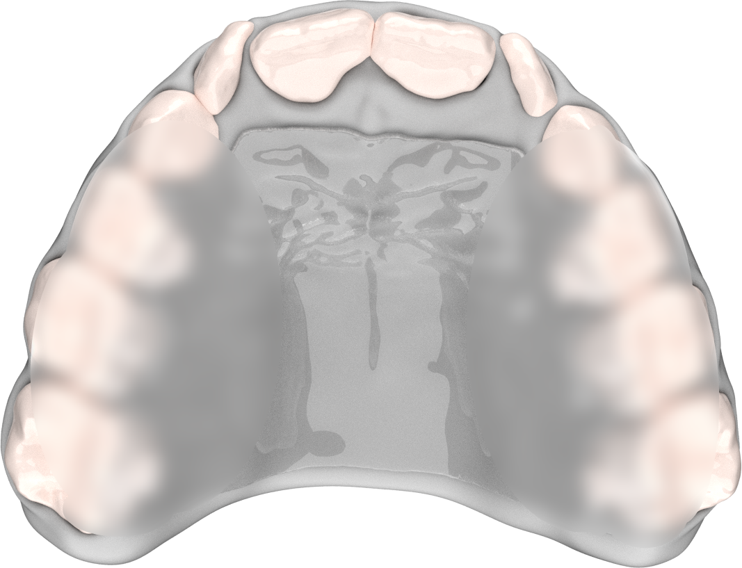 Palatal expanser – Home Page